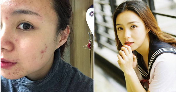 Công khai mặt mộc đầy mụn, cô gái chua chát: Ngũ quan đẹp mà da xấu thì ...